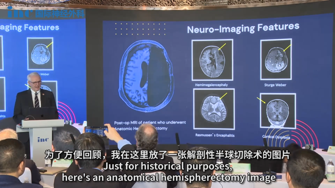 「INC云端峰会」国际癫痫大咖Rutka难治性癫痫30+年经验：大脑半球切除术- 大数跨境